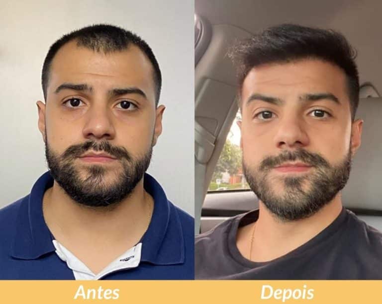 A N°1 em Transplante Capilar na América Latina - Stanleys Hair